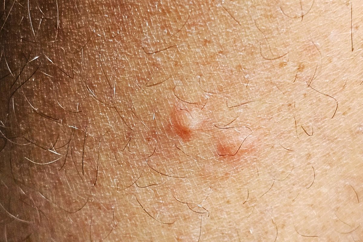 Sandflies in Neuseeland: 8 Tipps zur Abwehr & Behandlung!